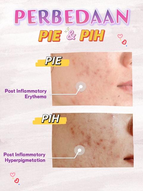 Postingan populer terbaru tentang #bekasjerawatpudar｜Lemon8