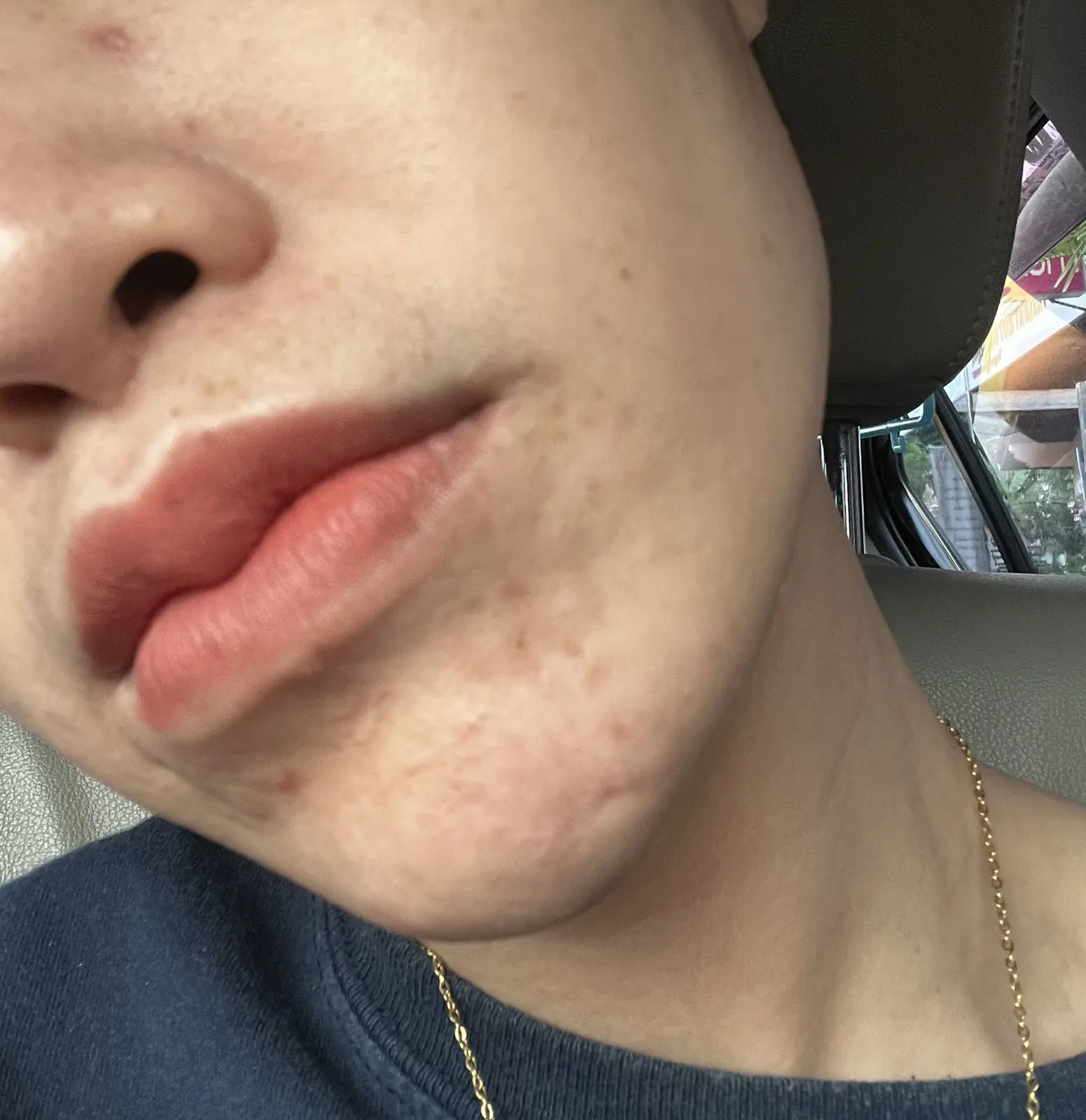 รักษาสิวสำหรับผิวแห้ง แพ้ง่าย | แกลเลอรีที่โพสต์โดย Mamuay | Lemon8