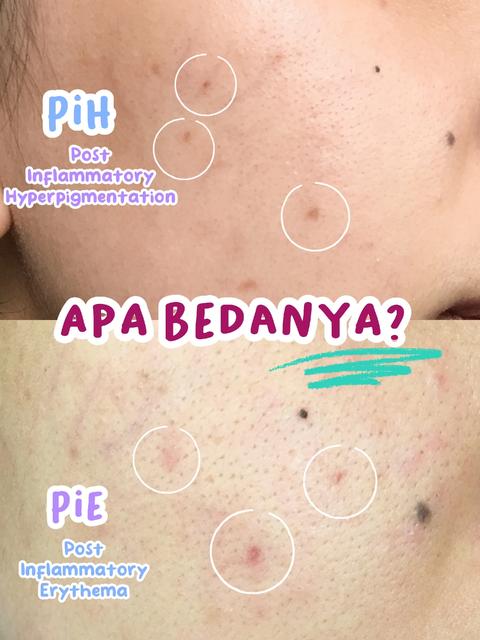 Postingan populer terbaru tentang #bekasjerawatpudar｜Lemon8